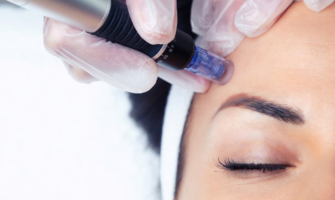 Beneficios del Dermapen con Botox - Centro de Estética Irene Sánchez